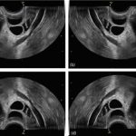 What is OPU? - Fertility Solutions